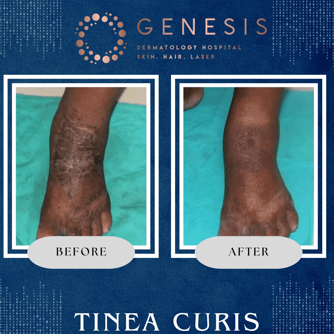 Genesis Dermatology | Skin, Hair & Laser Excellence in Chennai