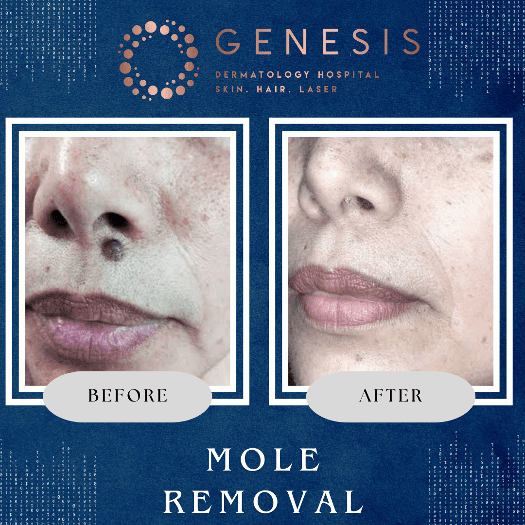 Genesis Dermatology | Skin, Hair & Laser Excellence in Chennai